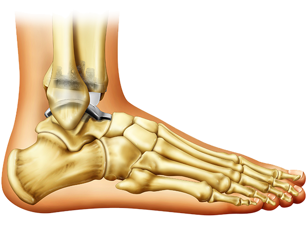 Total Ankle Replacement - exac.co.uk