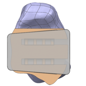 Vantage Ankle Mobile Bearing System | Exactech