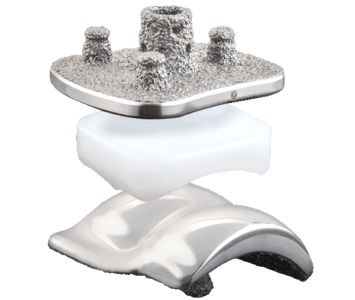 Vantage Ankle Mobile Bearing System | Exactech