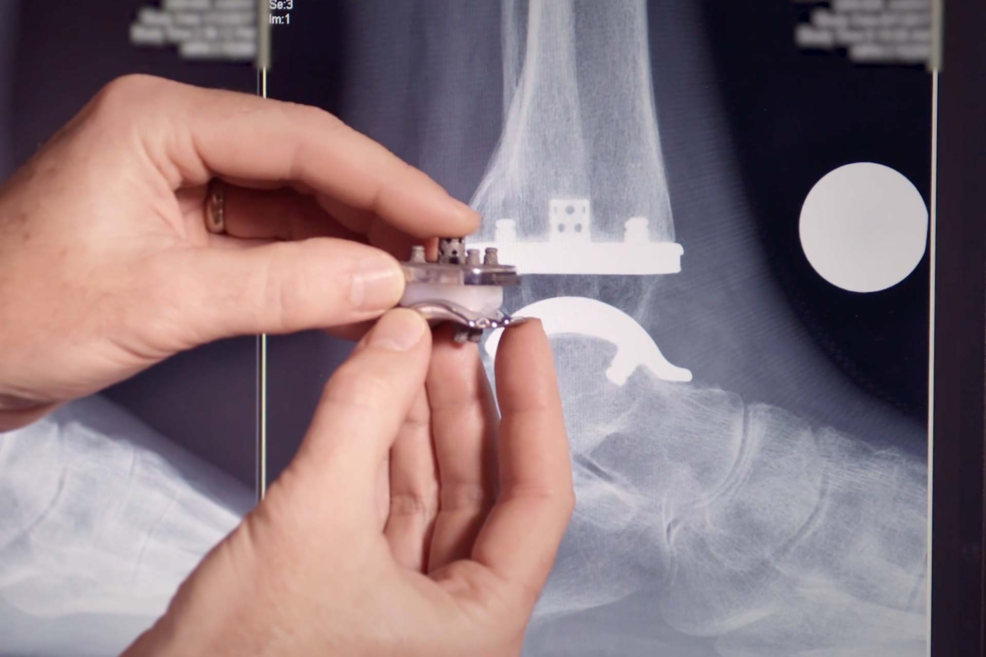 Ankle Replacement Surgery | Surgical Treatment Options | Exactech