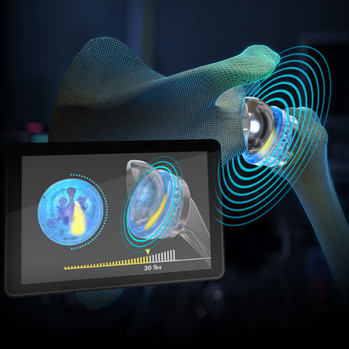 Active Intelligence | Exactech